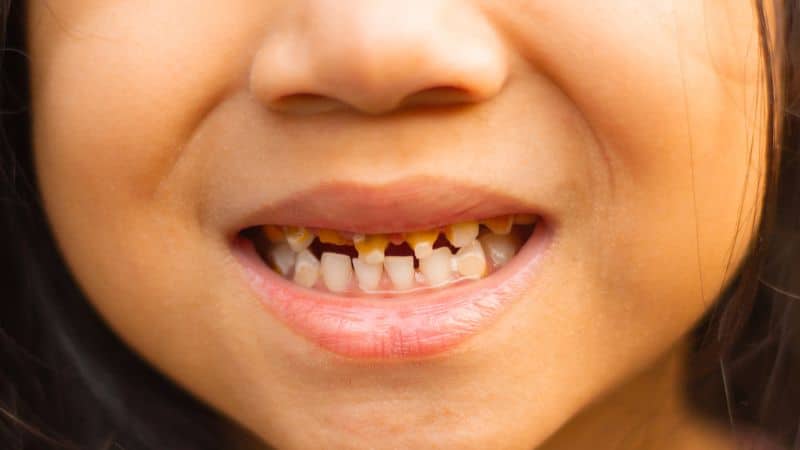 Carie sui denti da latte - Dental Competence Grosseto